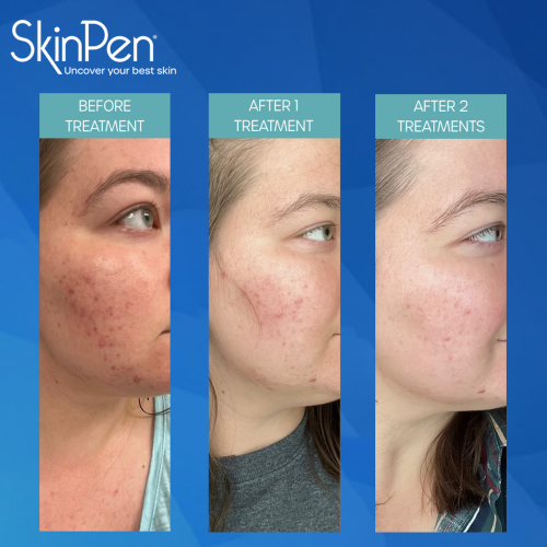 Microneedling - Magnolia & Steel Medi Spa - Graham, Washington